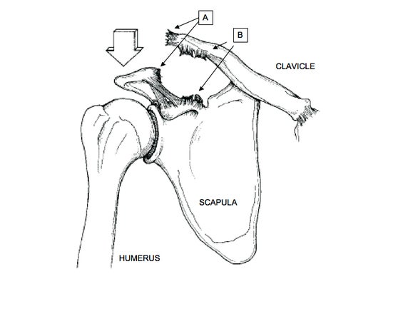 Shoulder separations explained - Velo
